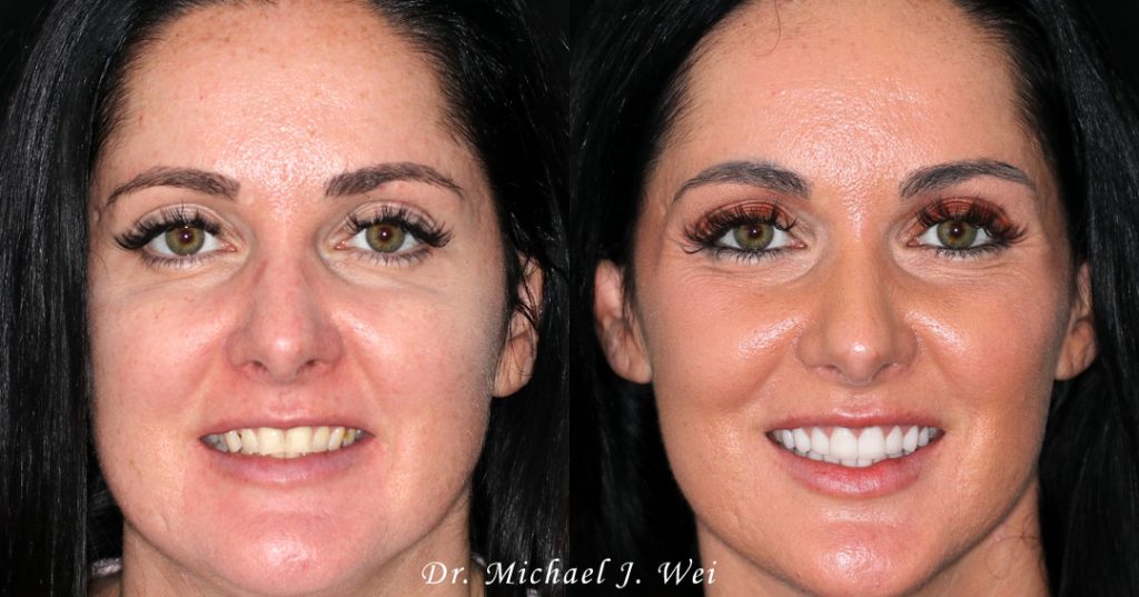 Cerinate Lumineers in Manhattan NYC no-prep, super thin, last up to 25 ...