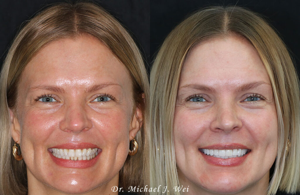 Smile Makeover of the Month: A Complete Veneer Transformation - Michael ...